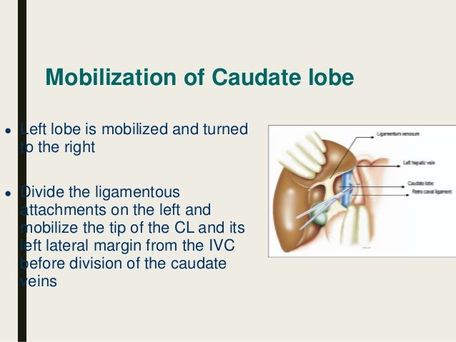 Caudate lobe resection by Dr Harsh Shah(www.gastroclinix.com)