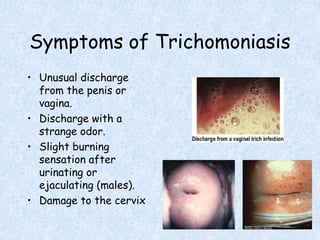 Trichomoniasis Male Discharge