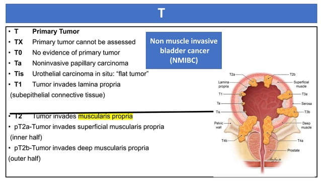 Ca Urinary Bladder anatomy to management | PPTX | Cancer | Diseases and ...