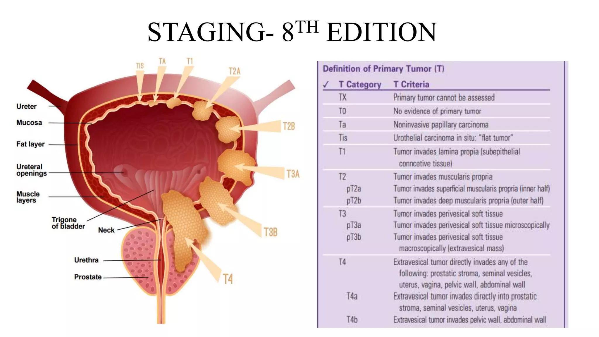CA URINARY BLADDER - STAGING & MANAGMENT.pptx