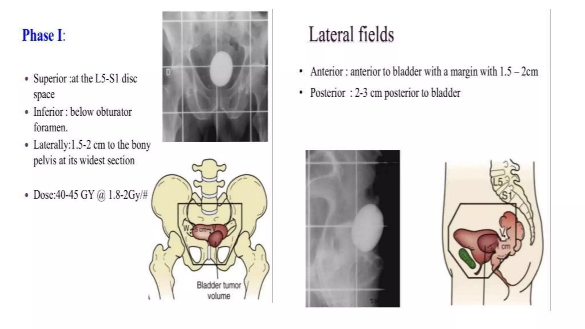 CA URINARY BLADDER - STAGING & MANAGMENT.pptx