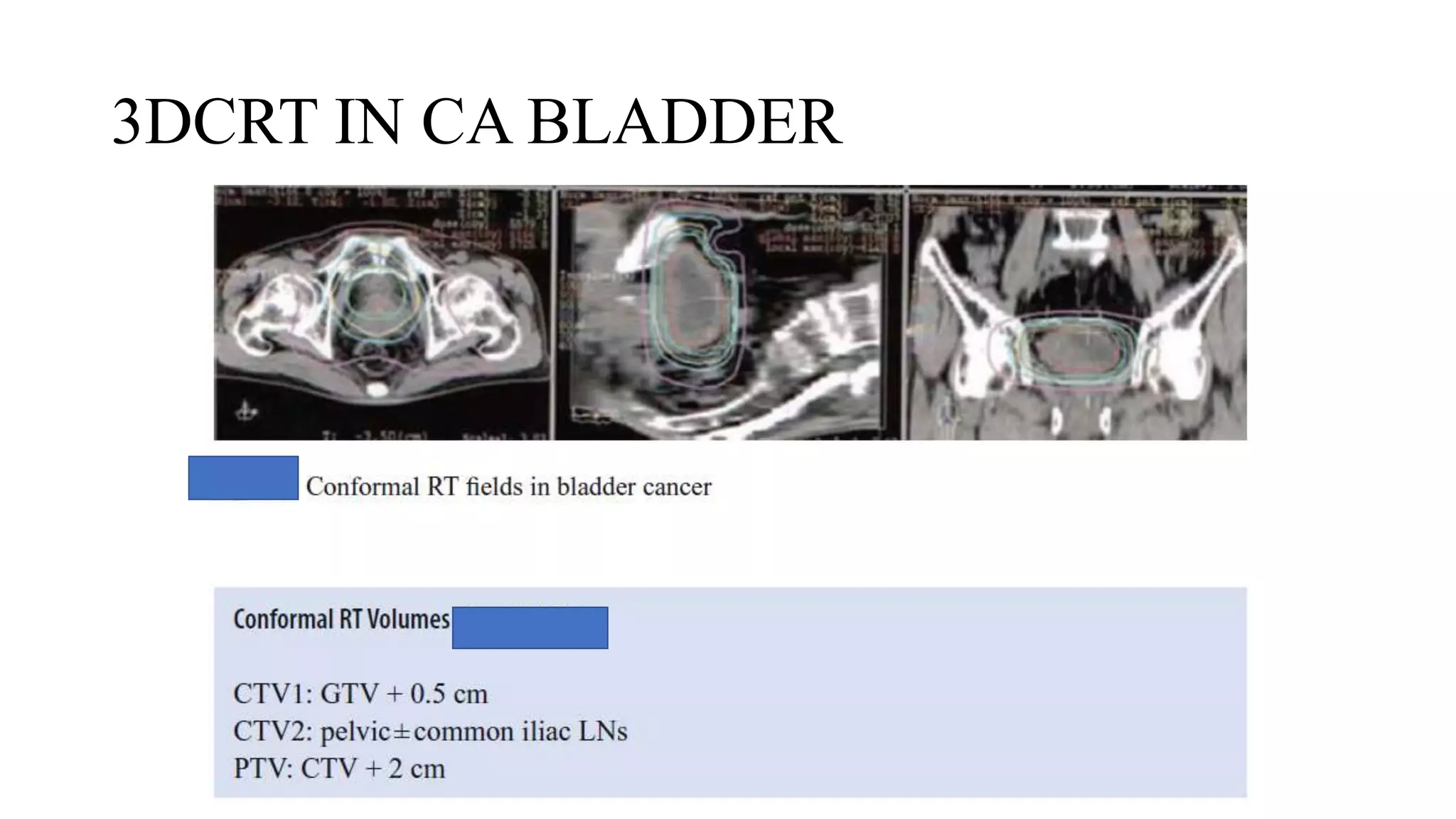 CA URINARY BLADDER - STAGING & MANAGMENT.pptx