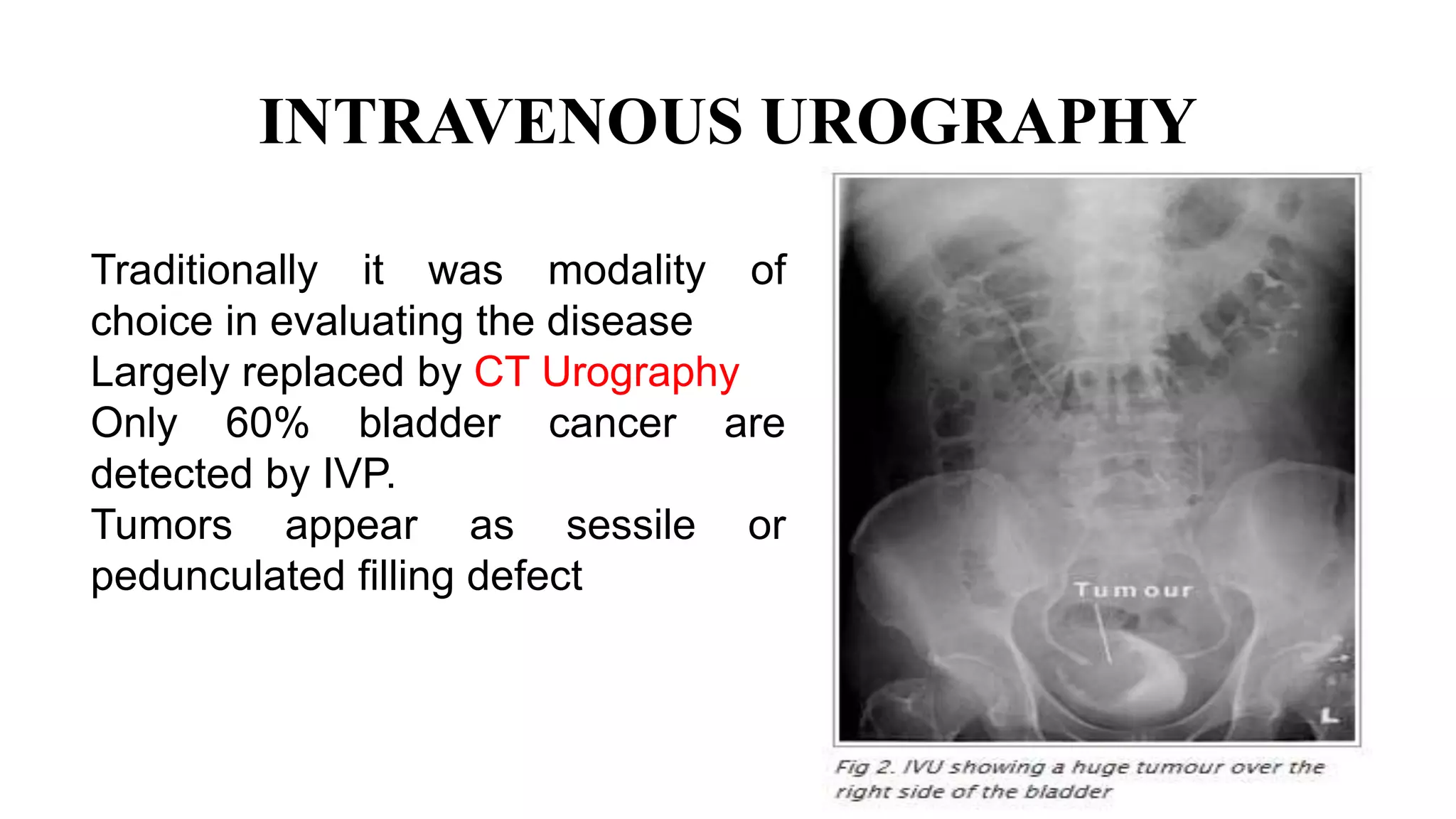 CA URINARY BLADDER - STAGING & MANAGMENT.pptx