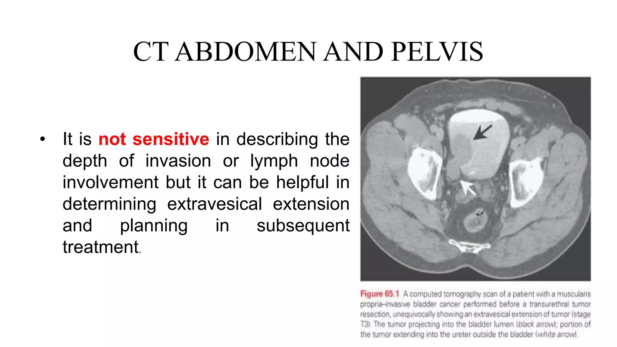 CA URINARY BLADDER - STAGING & MANAGMENT.pptx