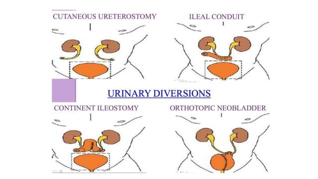 CA URINARY BLADDER - STAGING & MANAGMENT.pptx | Cancer | Diseases and ...