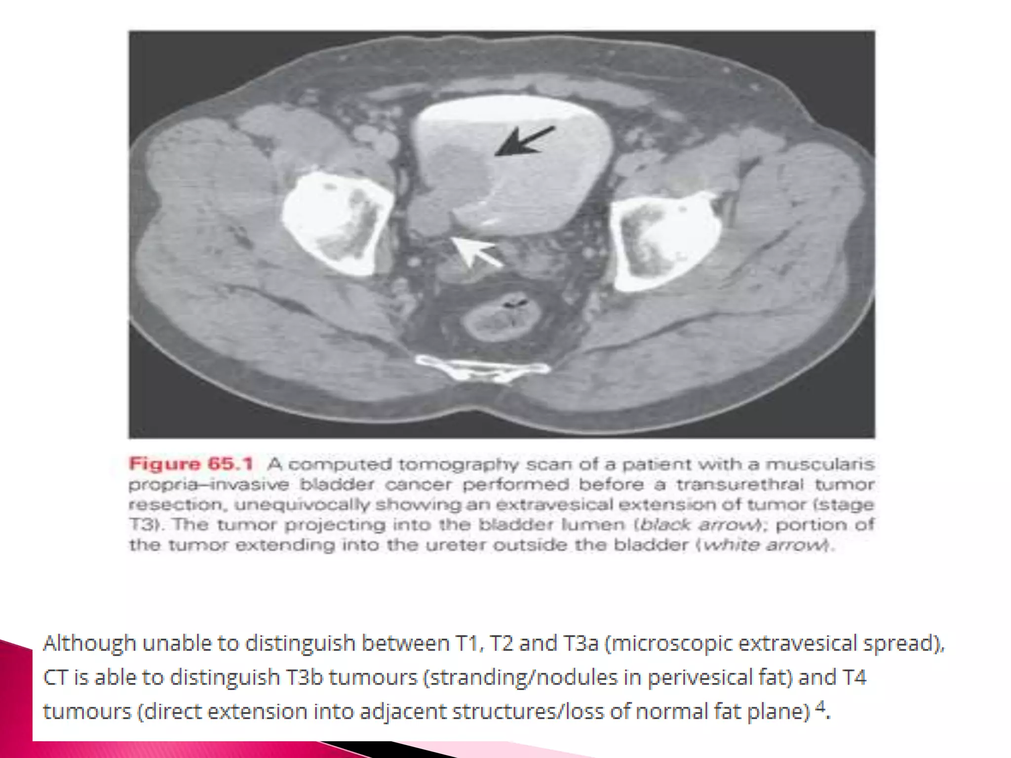 Ca urinary bladder management | PPTX