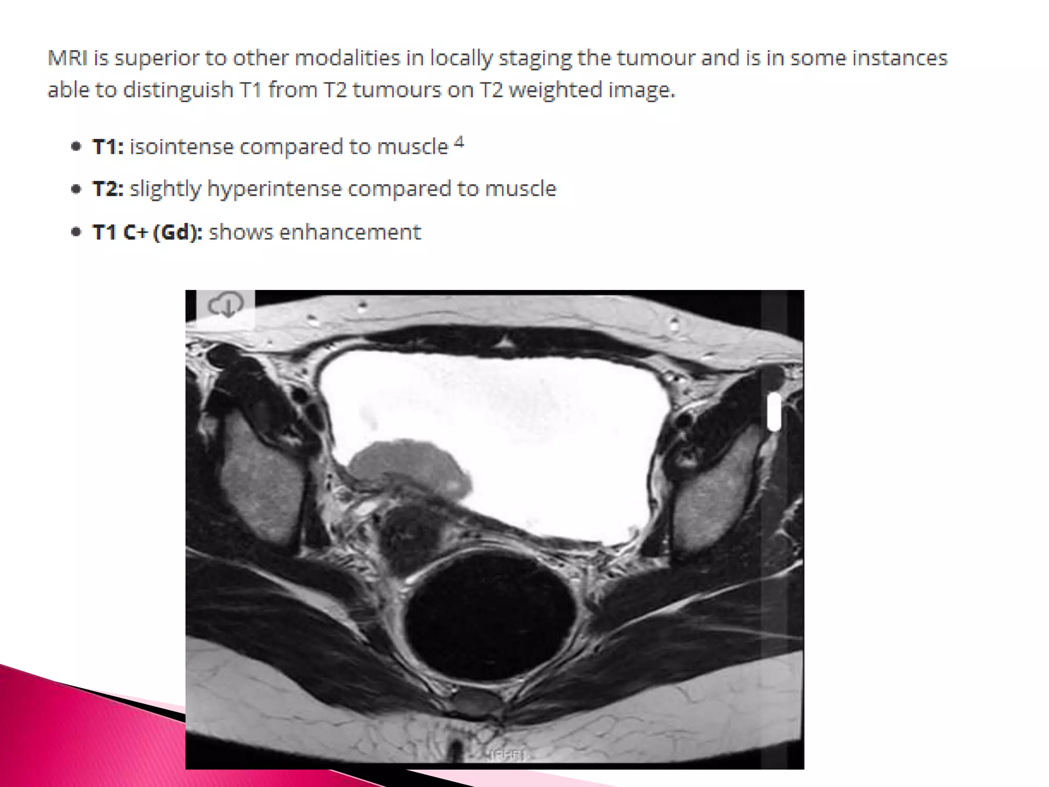 Ca urinary bladder management | PPTX