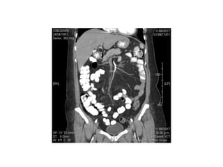CAUSAS DE DOLOR ABDOMINAL NO COMUN.pptx
