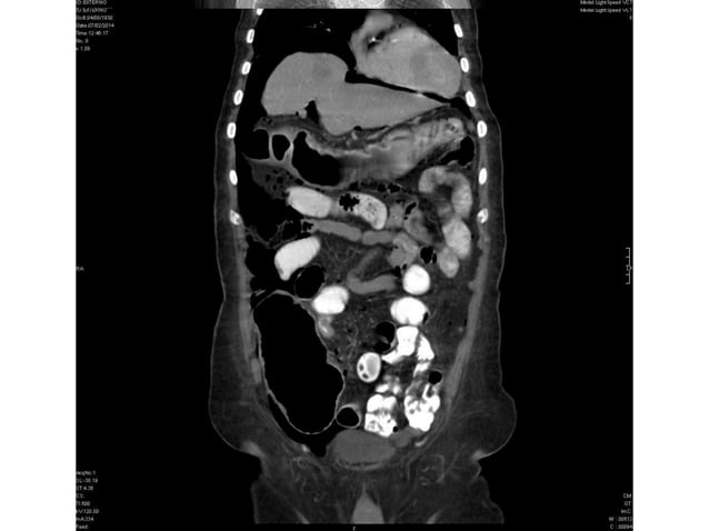 CAUSAS DE DOLOR ABDOMINAL NO COMUN.pptx