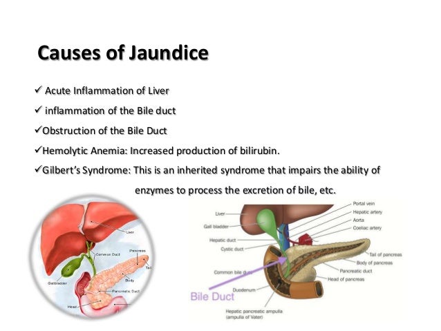 Causes and treatment methods for jaundice