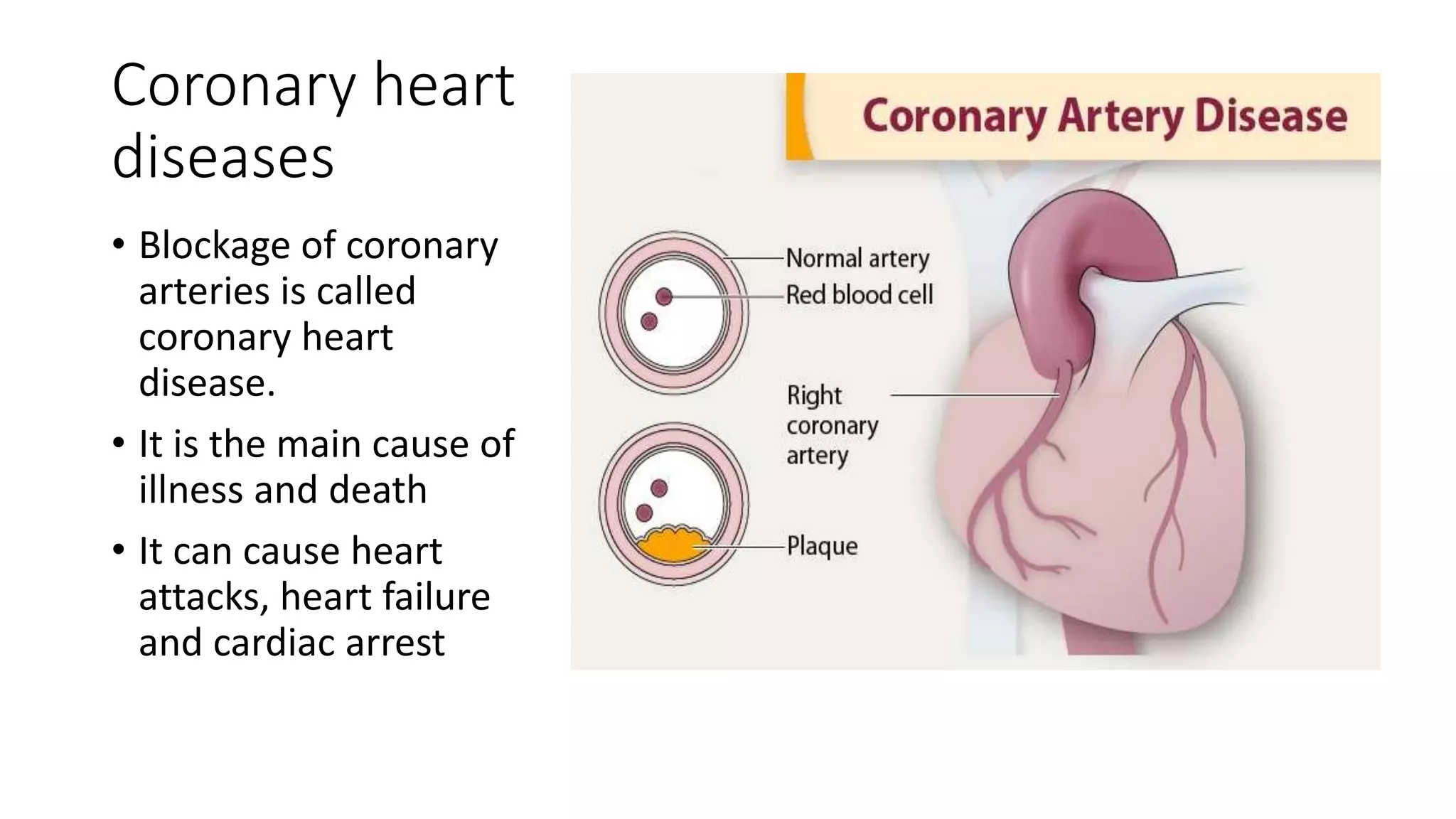 Causes and treatment of chd | PPTX