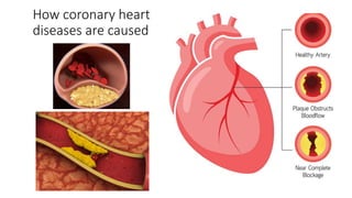 Causes and treatment of chd | PPTX