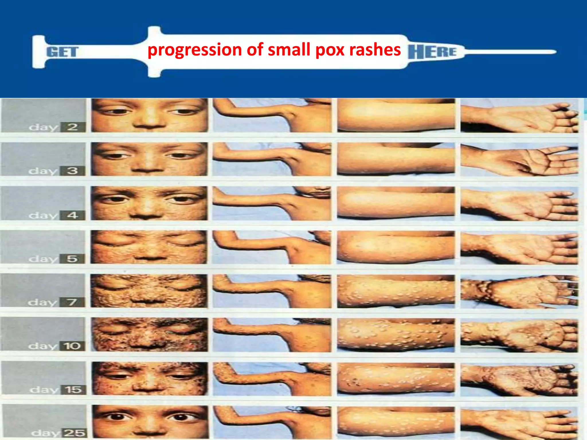 Small Pox Ppt