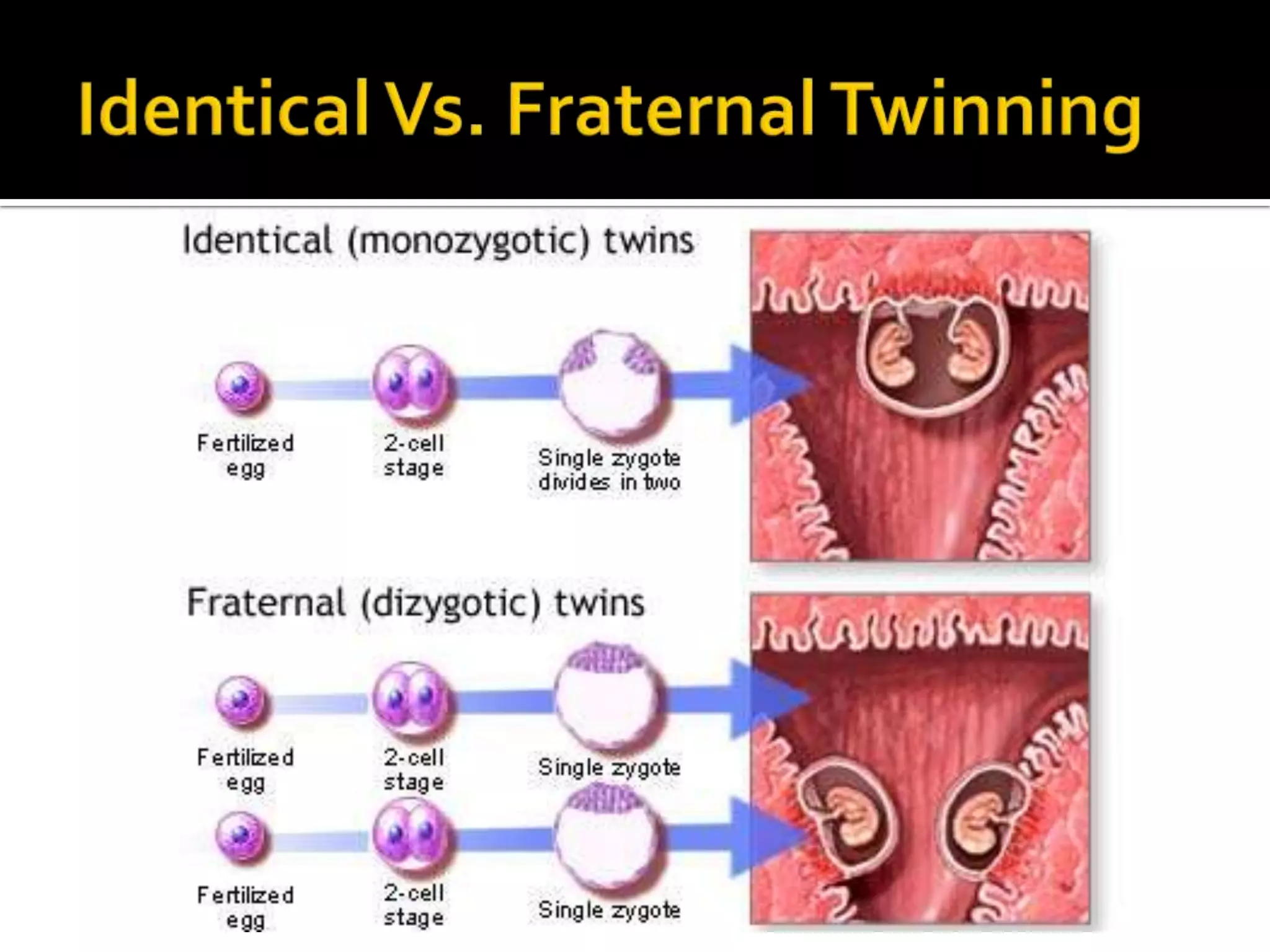 Causes & Complications Of Multiple Births | PPT