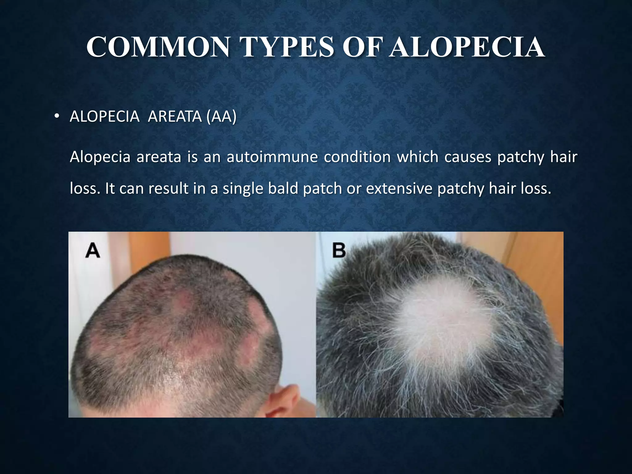 Causes of Alopecia.pptx