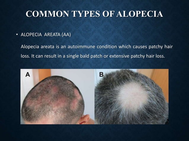 Causes of Alopecia.pptx | Skin and Dermatology | Diseases and Conditions