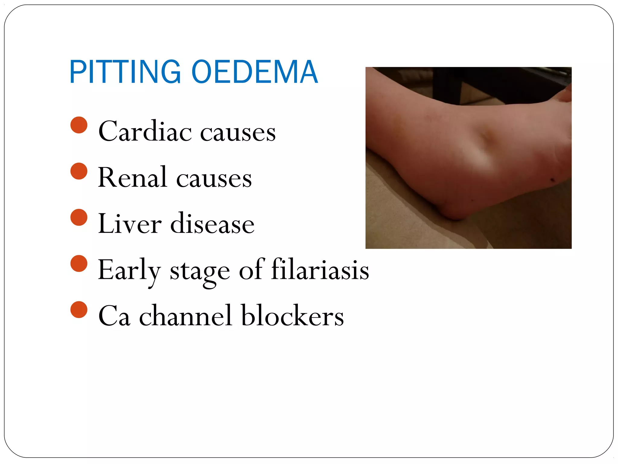 Causes of edema | PPT