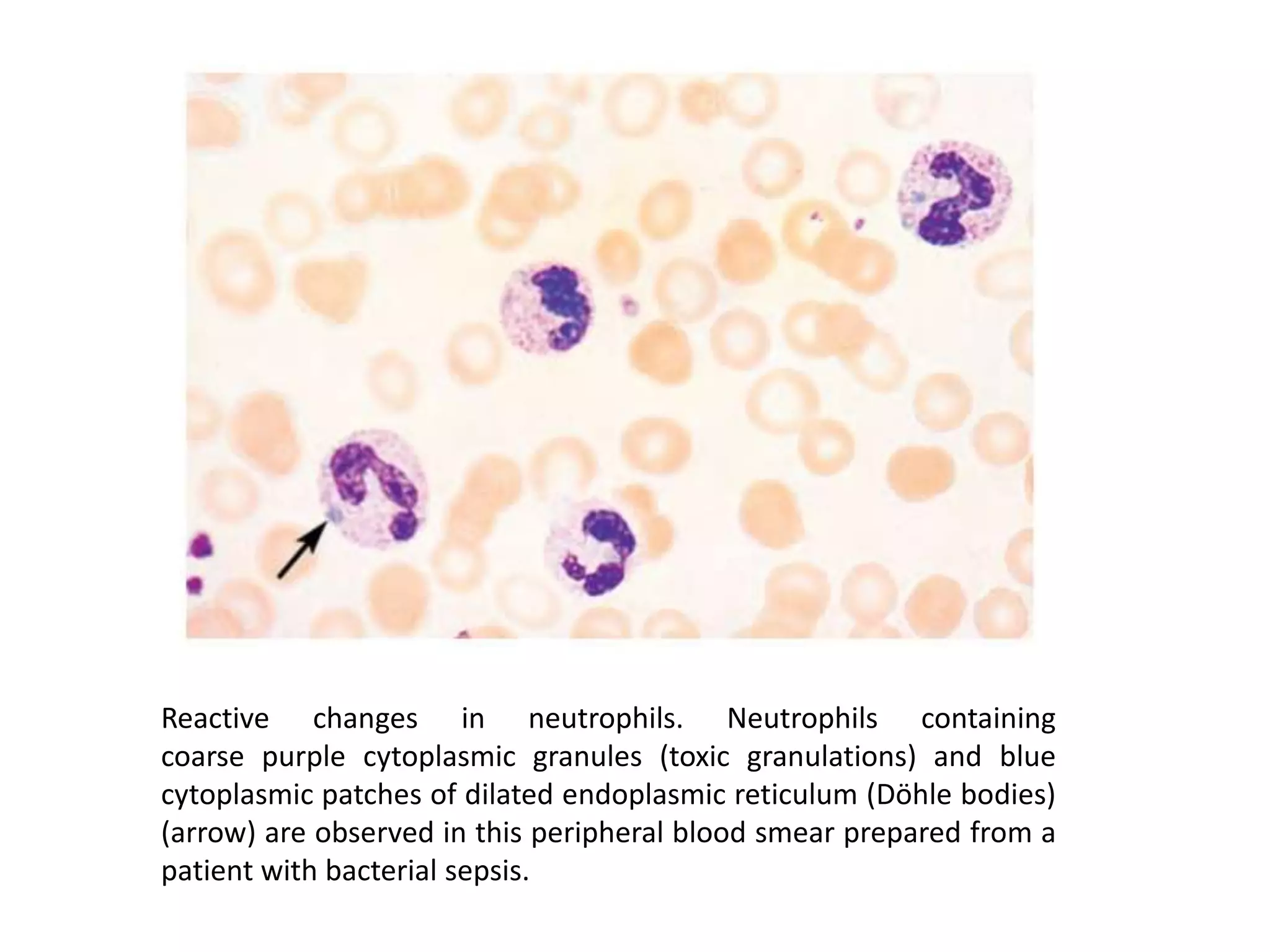 Causes of Leukocytosis, Leokopenia, Lymphocytosis and Leukemoid ...