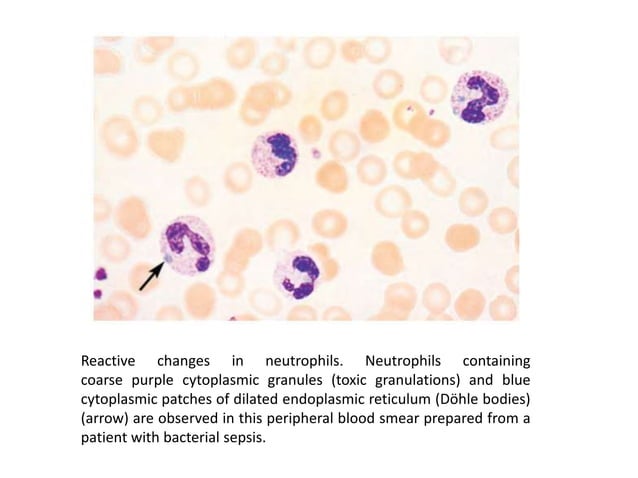 Causes of Leukocytosis, Leokopenia, Lymphocytosis and Leukemoid ...