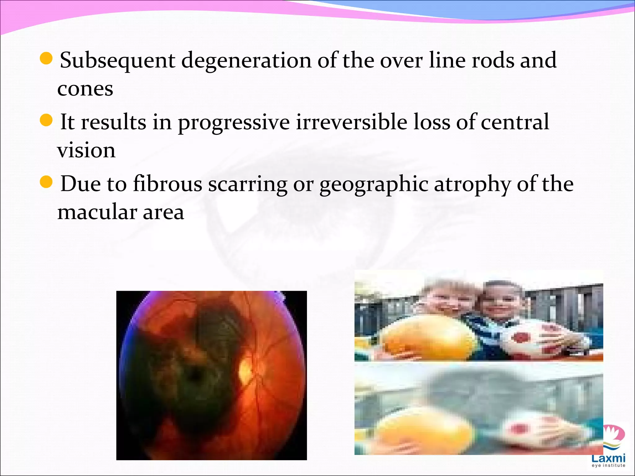 Causes of low vision in adult | PPT