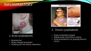 Causes of lymphadenopathy.pptx