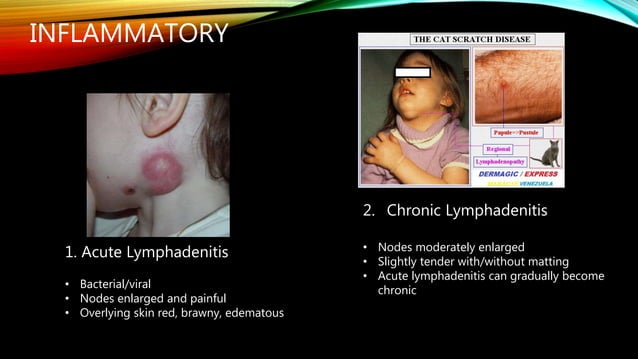 Causes of lymphadenopathy.pptx