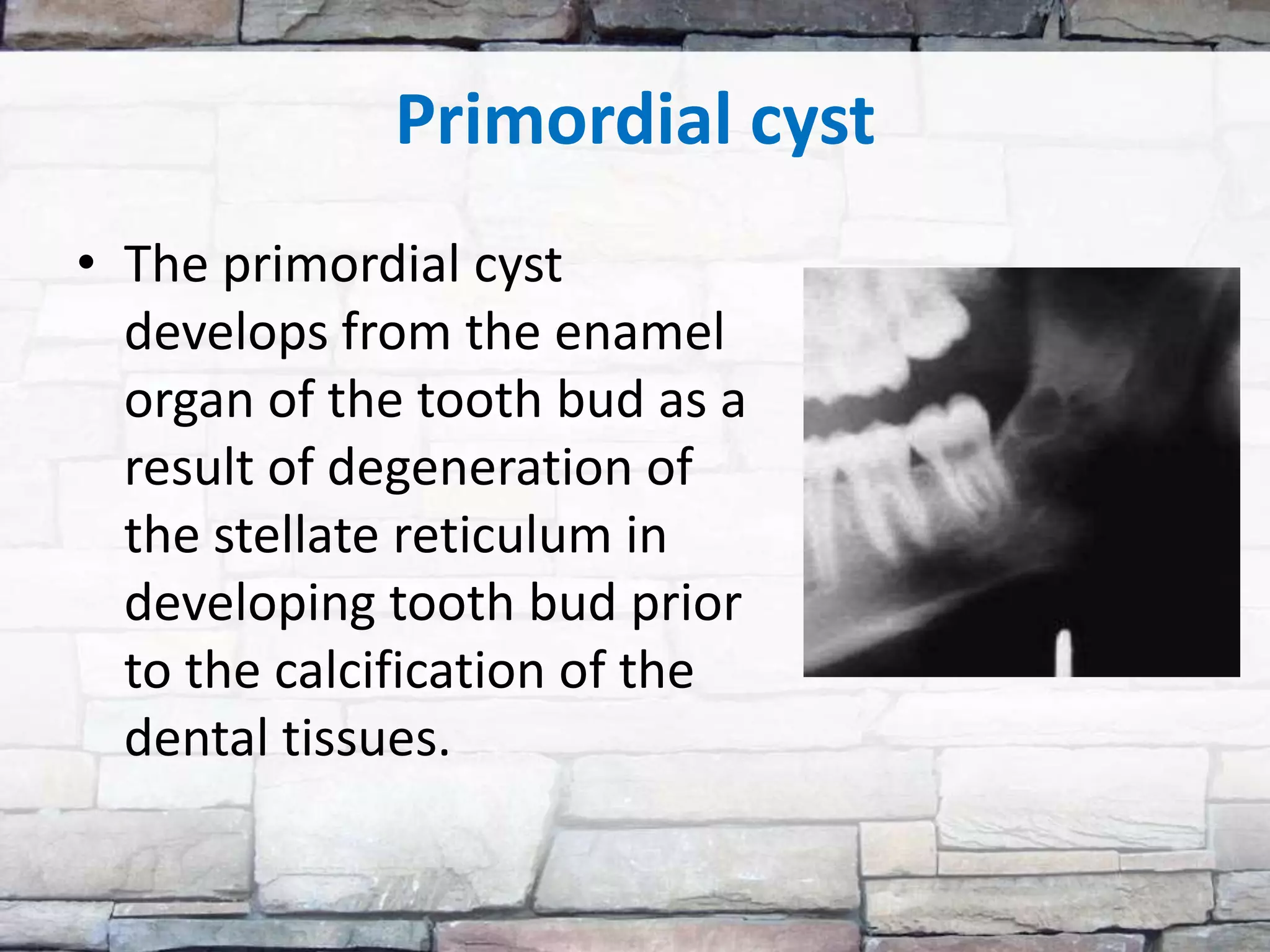 Causes of odontogenic cyst | PPTX | Dental Health | Diseases and Conditions