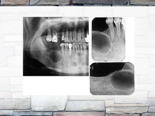 Causes of odontogenic cyst | PPTX | Dental Health | Diseases and Conditions
