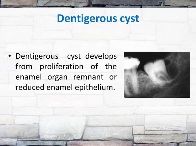 Causes of odontogenic cyst | PPTX | Dental Health | Diseases and Conditions
