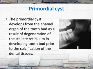Causes of odontogenic cyst | PPTX | Dental Health | Diseases and Conditions