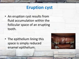 Causes of odontogenic cyst | PPTX | Dental Health | Diseases and Conditions