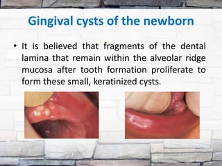 Gingival Cyst Of The Newborn