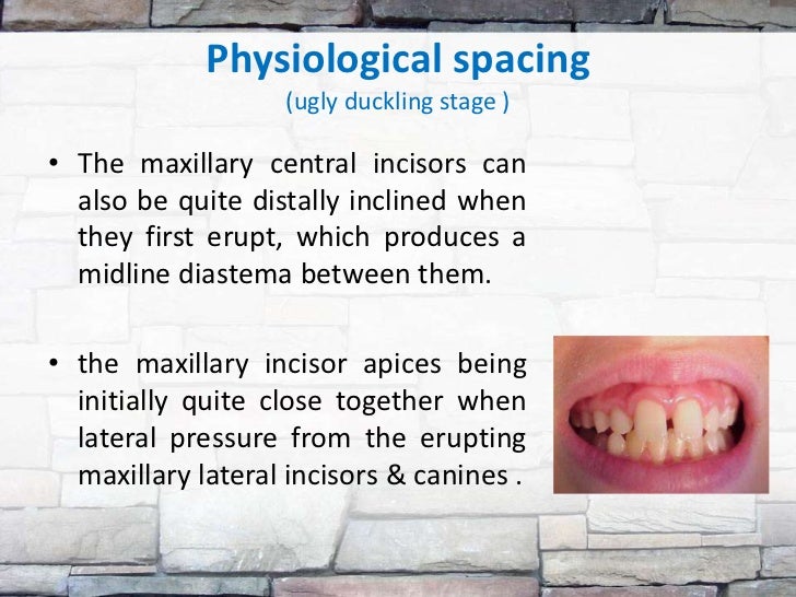 Causes of spacing