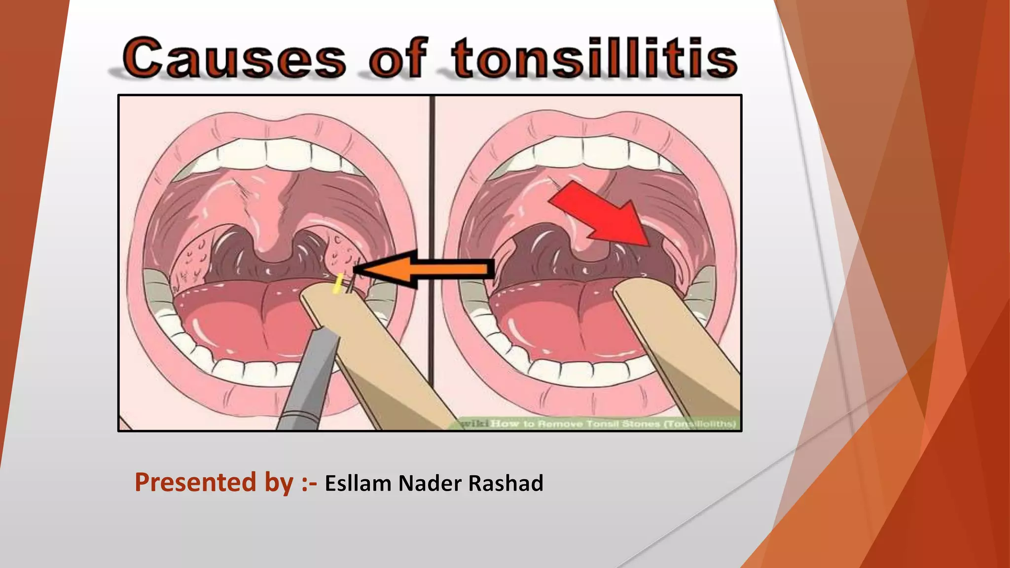 Causes and Symptoms of Tonsillitis | PPT