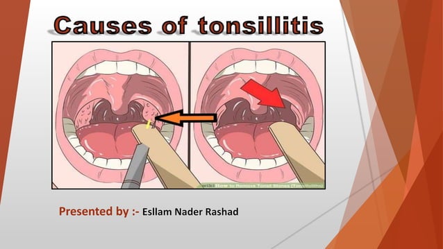 Causes Of Tonsillitis Pptx