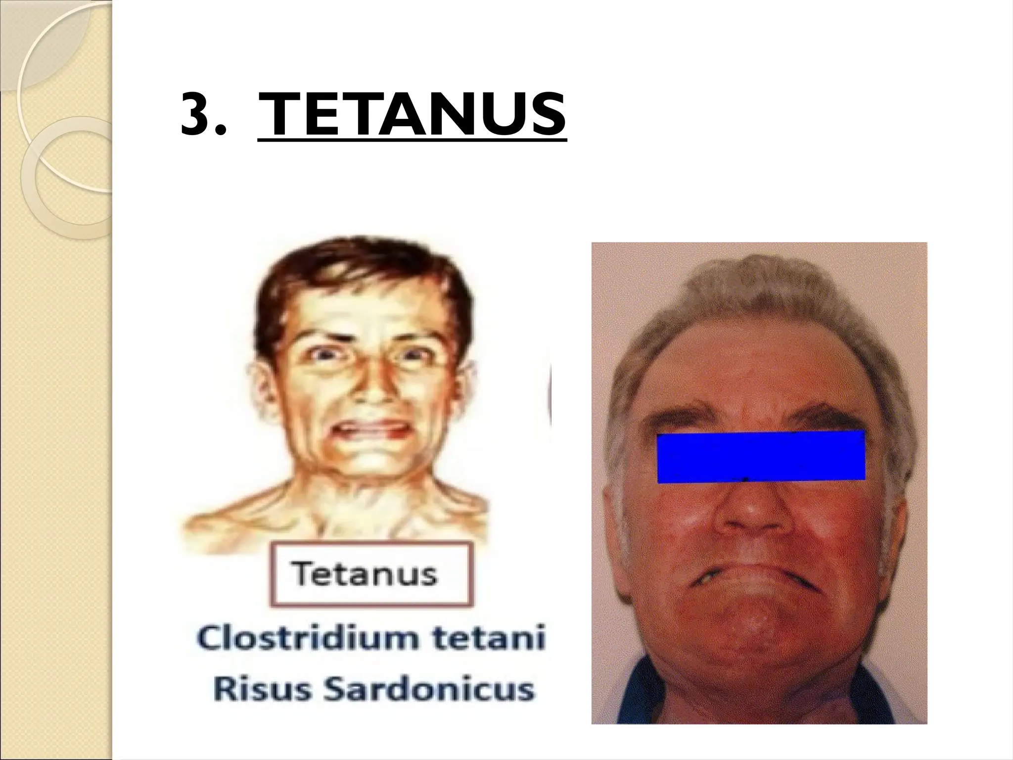 causes of trismus final MYOFACIAL TMPD.pptx