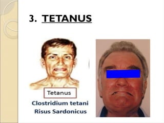 causes of trismus final MYOFACIAL TMPD.pptx