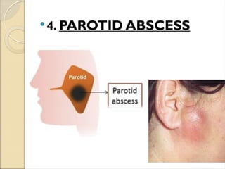 causes of trismus final MYOFACIAL TMPD.pptx