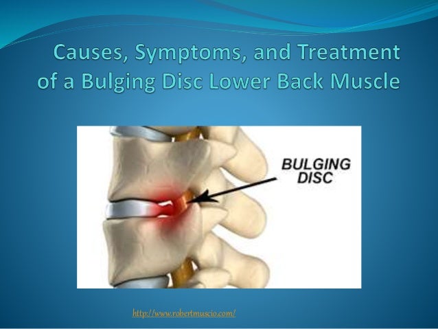 Causes, Symptoms, and Treatment of a Bulging Disc Lower Back Muscle Causes, Symptoms, and Treatment of a Bulging Disc Lower Back Muscle