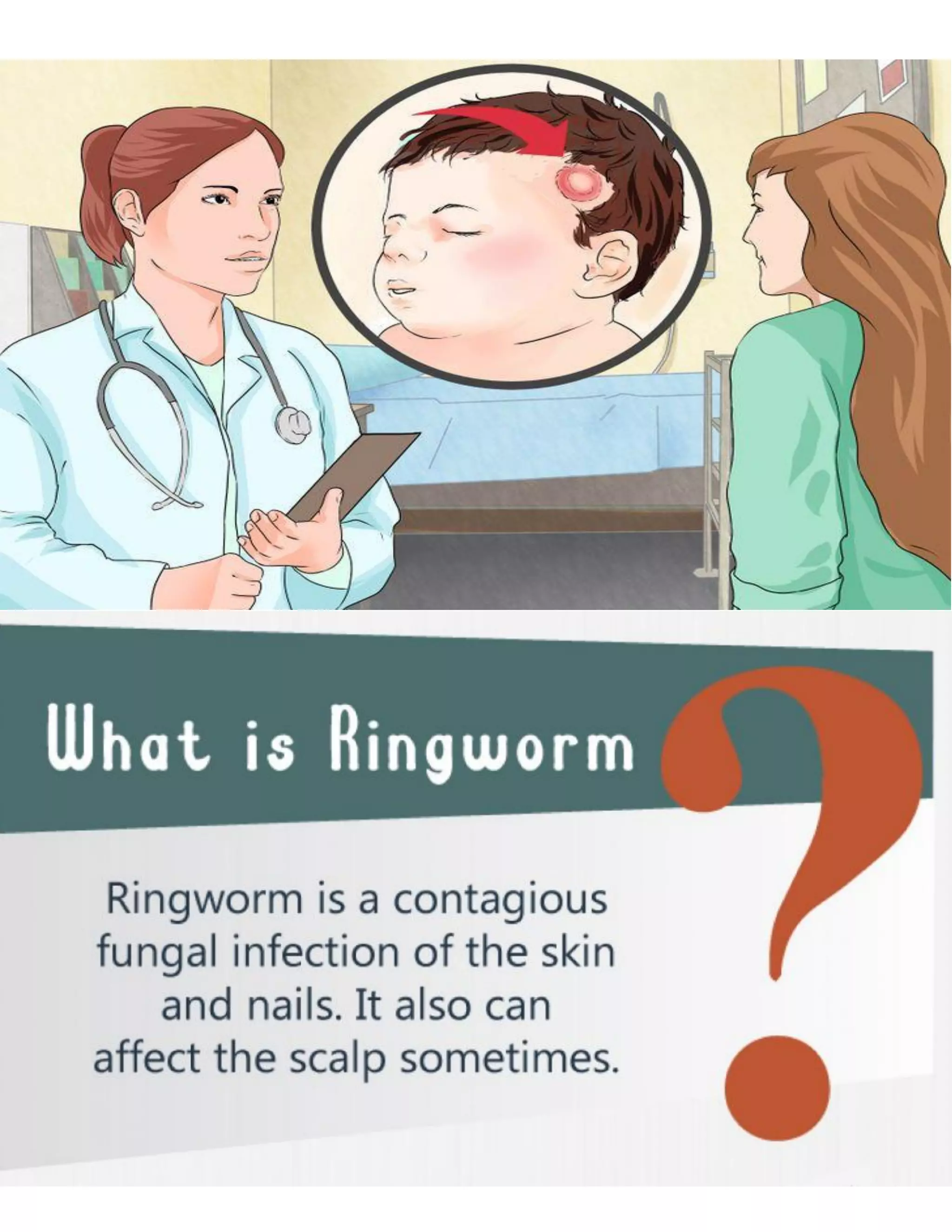 Causes, symptoms and treatments for ringworm - Curecity | PDF