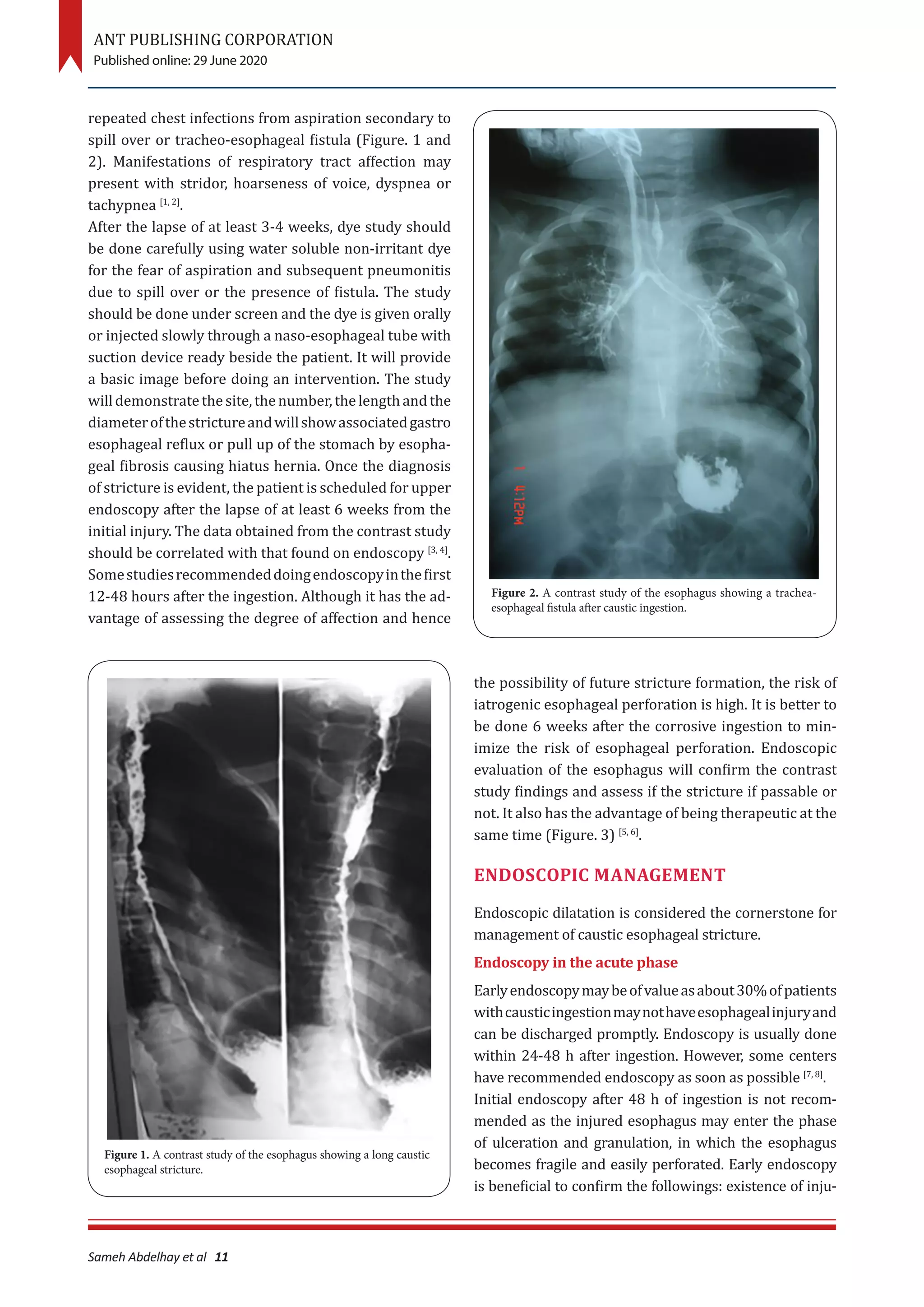 Caustic esophageal stricture from diagnosis untill cure | PDF