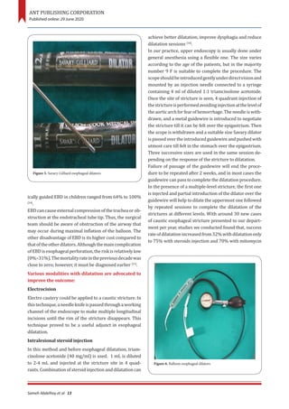 Caustic esophageal stricture from diagnosis untill cure | PDF