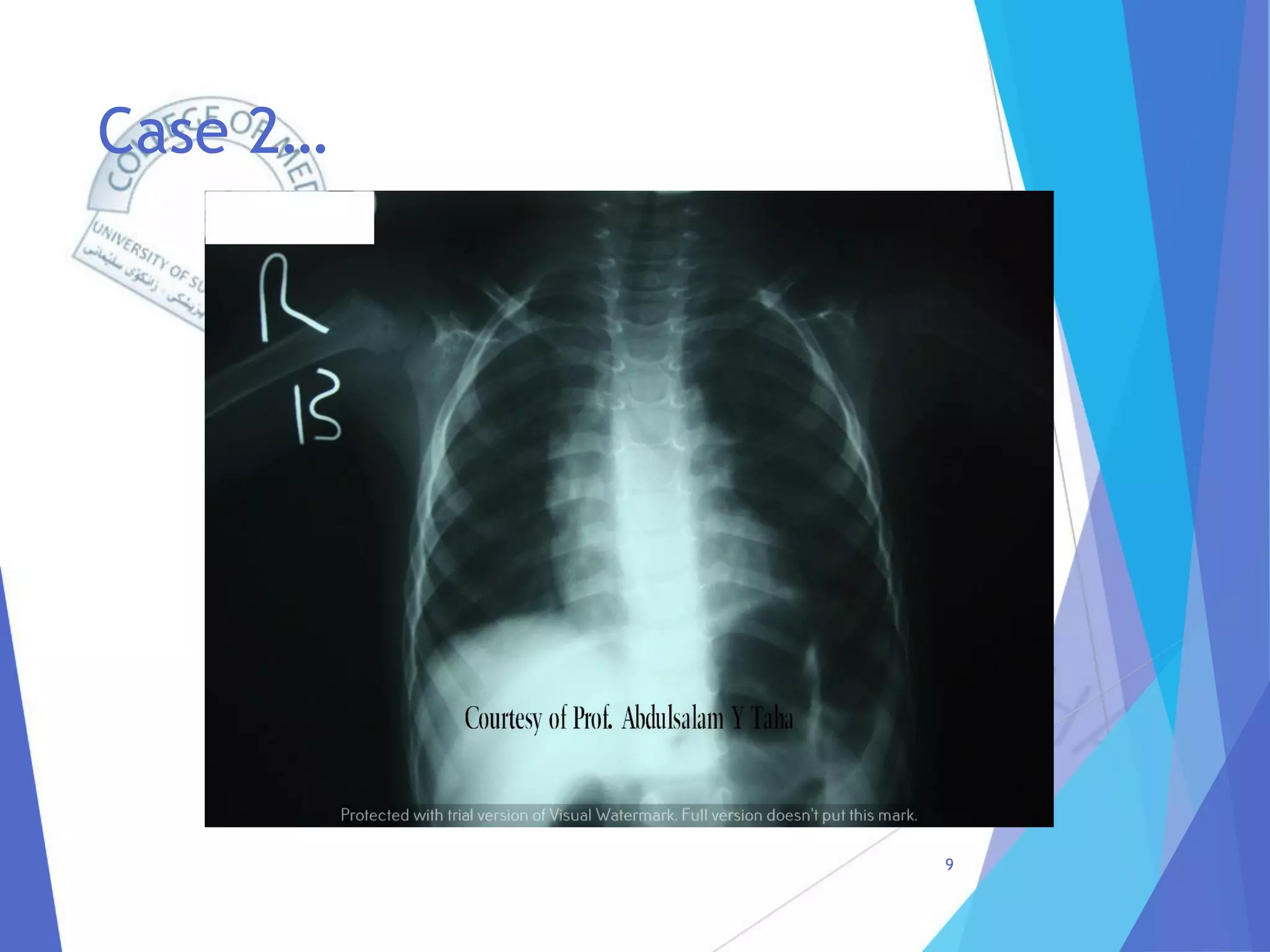 Caustic Esophageal Strictures.pdf