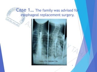 Caustic Esophageal Strictures.pdf