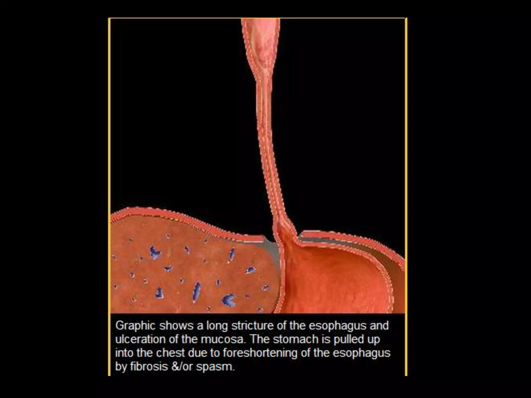 Caustic esophagitis | PPTX