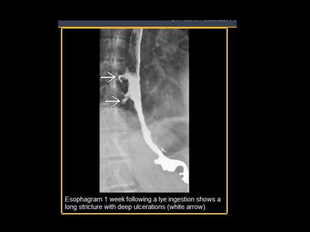Caustic esophagitis | PPTX