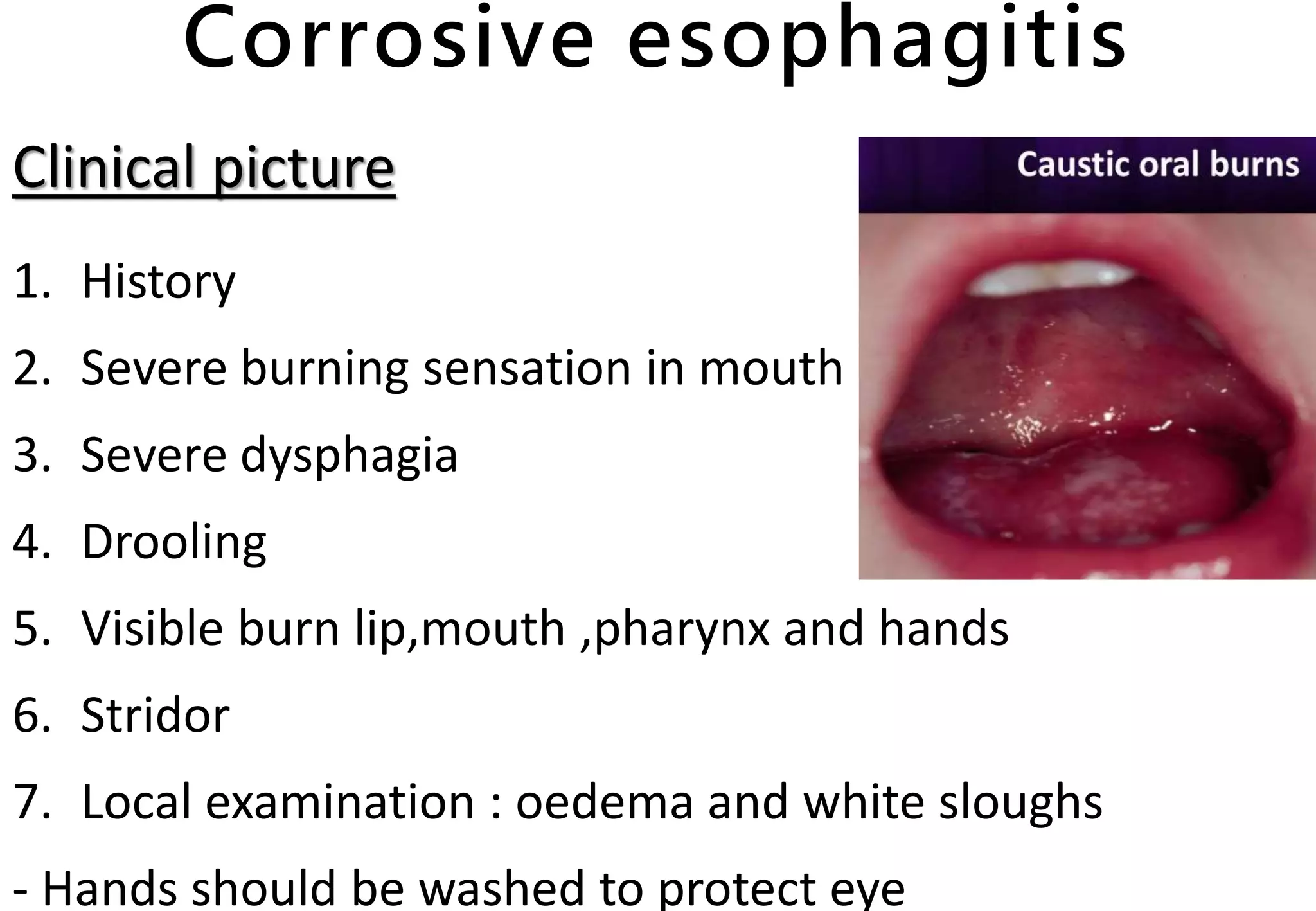 Caustic ingestion-esophageal stricture محاضره 2.pptx
