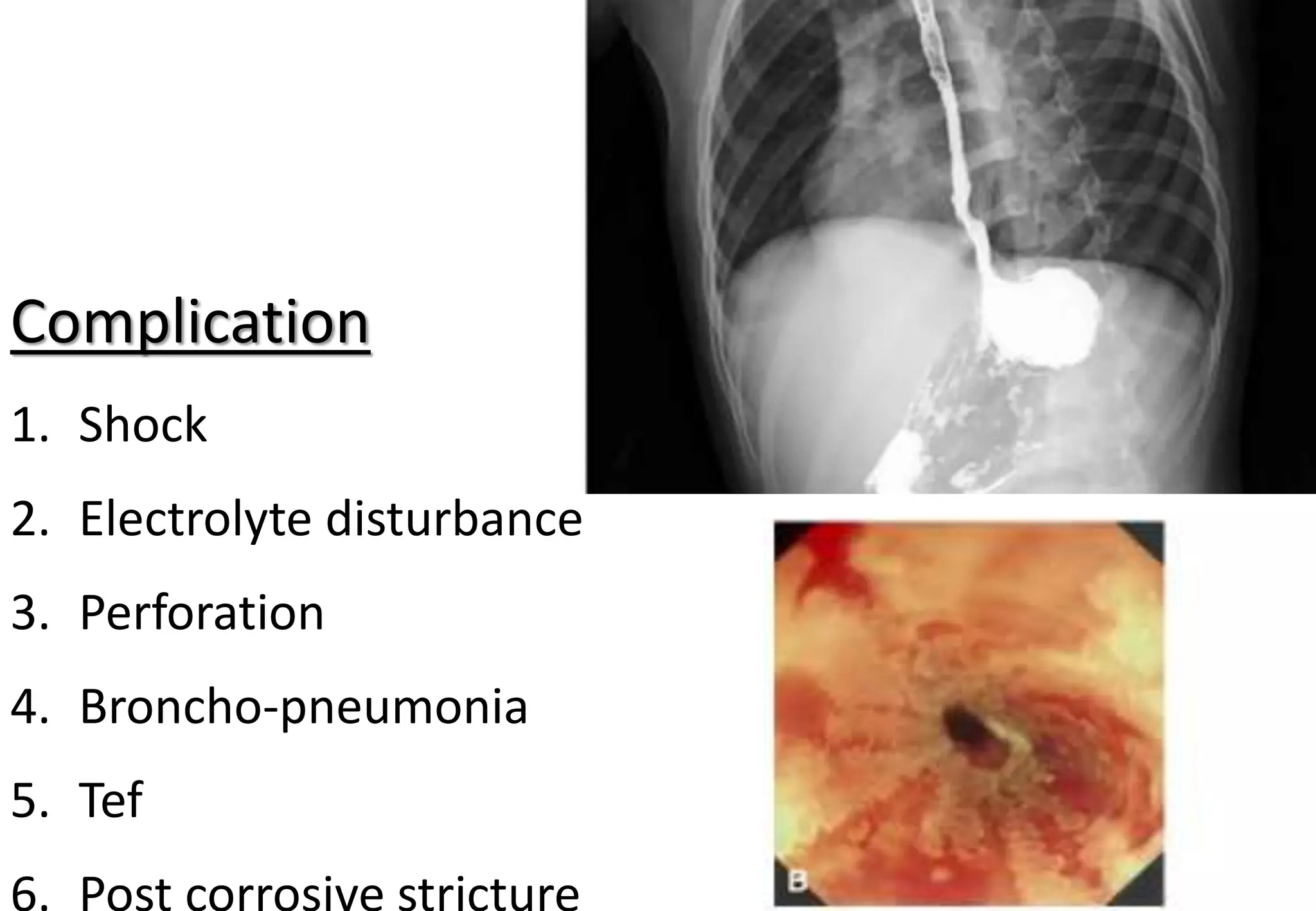 Caustic ingestion-esophageal stricture محاضره 2.pptx