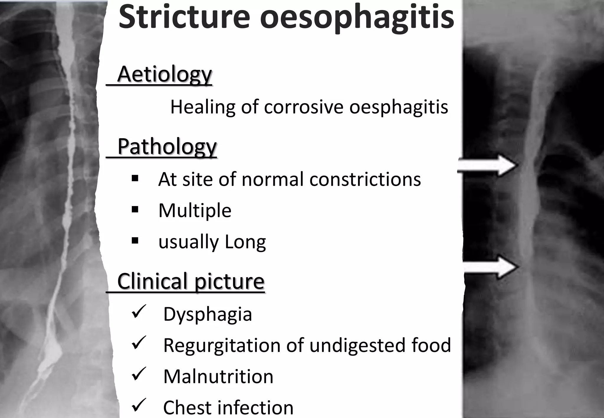 Caustic ingestion-esophageal stricture محاضره 2.pptx
