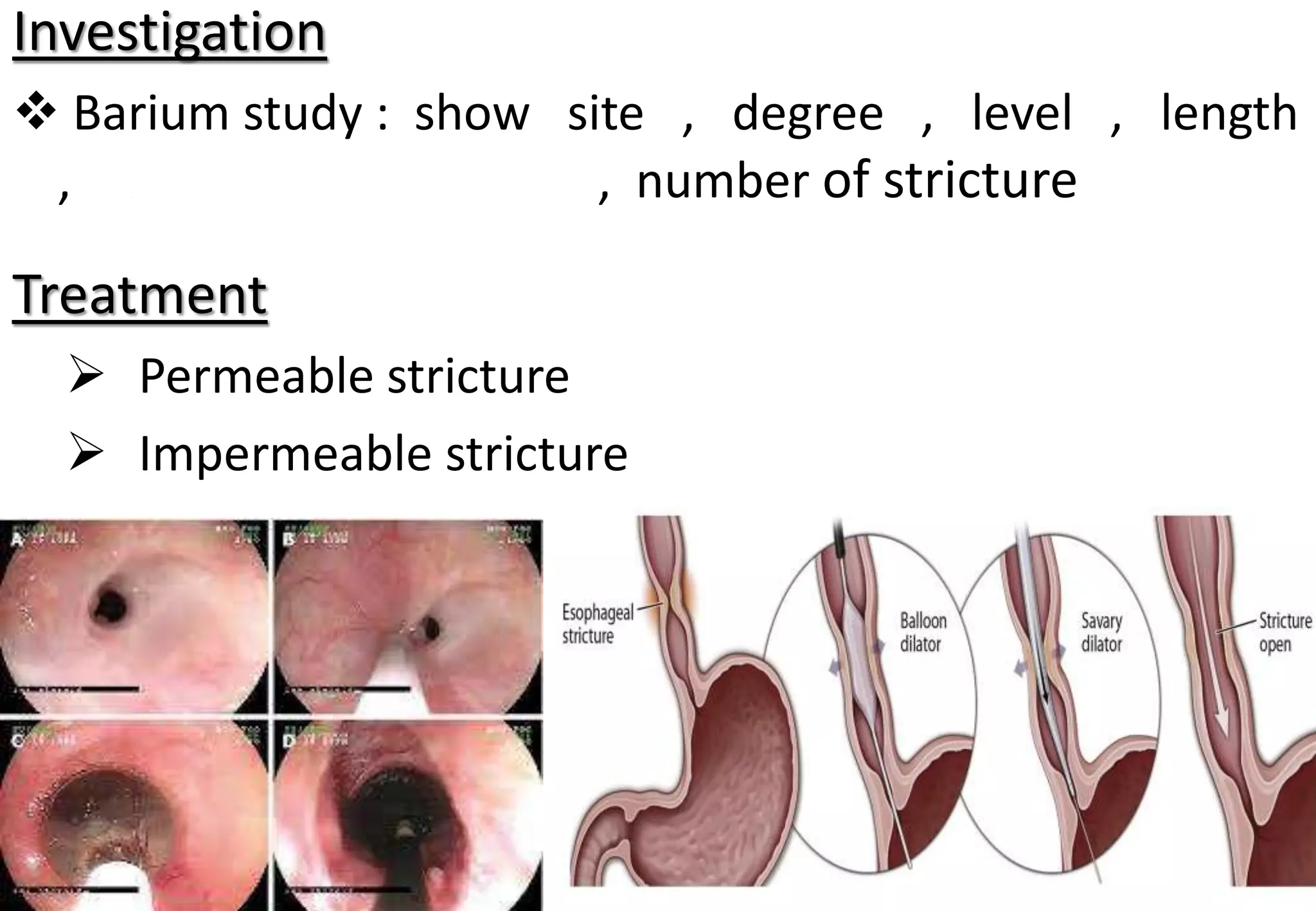 Caustic ingestion-esophageal stricture محاضره 2.pptx